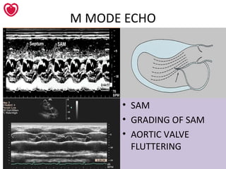 Management of hypertrophic cardiomyopathy | PPT