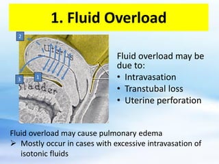 Management of hysteroscopic complication | PDF