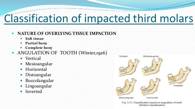 Management of impacted3rd molar