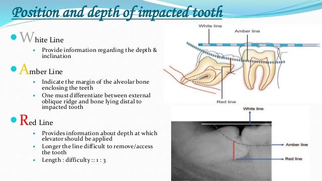 Management of impacted3rd molar