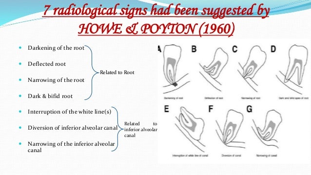 Management of impacted3rd molar