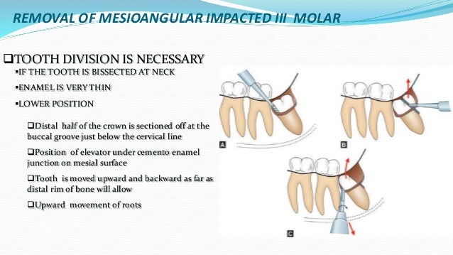 Management of impacted3rd molar