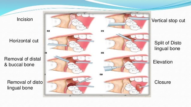 Management of impacted3rd molar