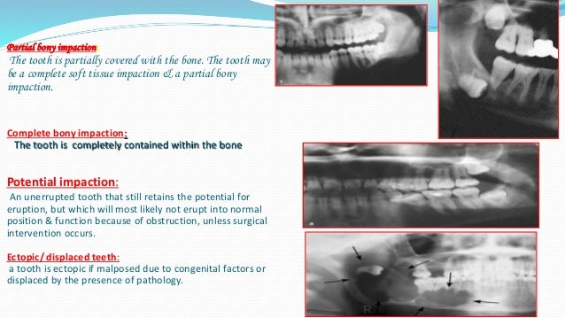 Management of impacted3rd molar