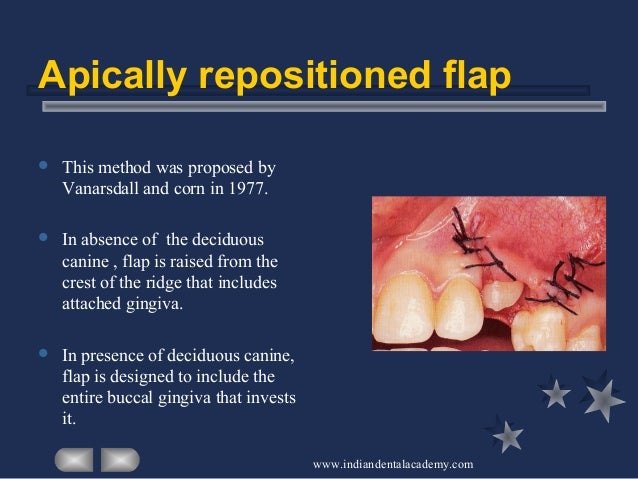 Management of impacted canine (2)