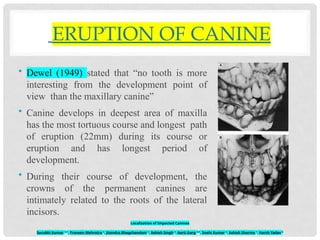 management OF IMPACTED CANINE LATEST.pptx