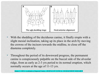 management OF IMPACTED CANINE LATEST.pptx