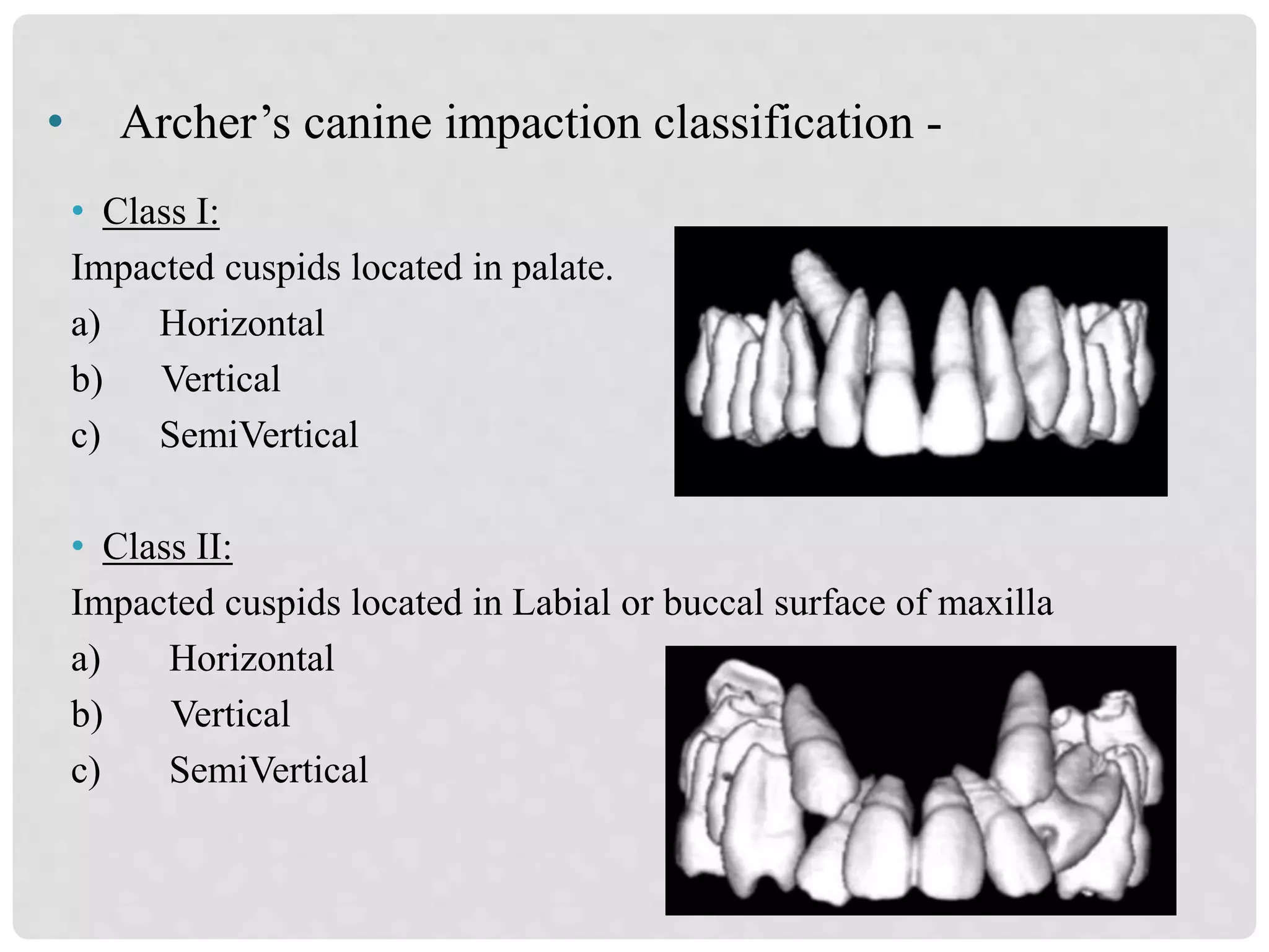 Management of impacted canines | PPTX