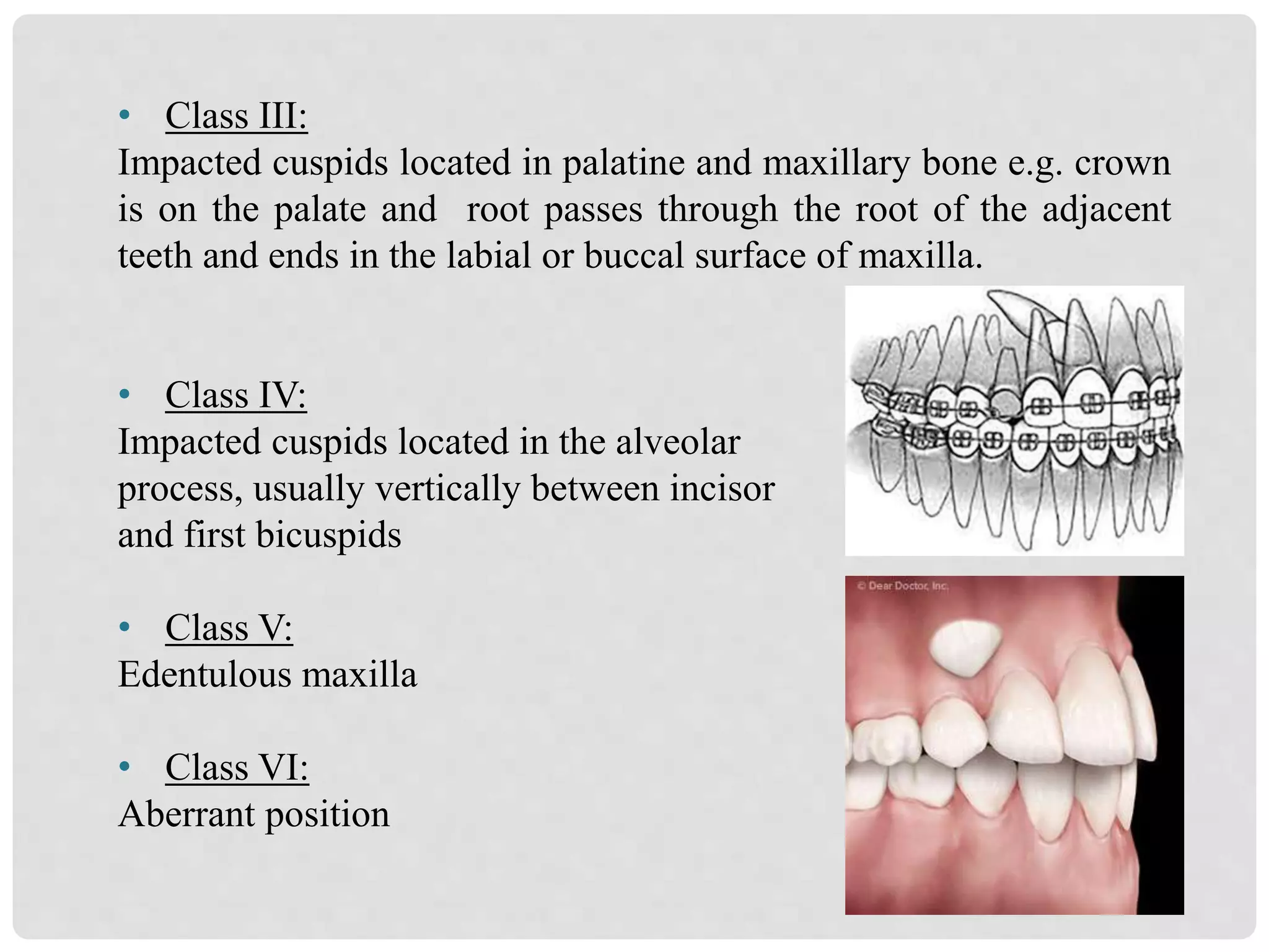 Management of impacted canines | PPTX | Dental Health | Diseases and ...