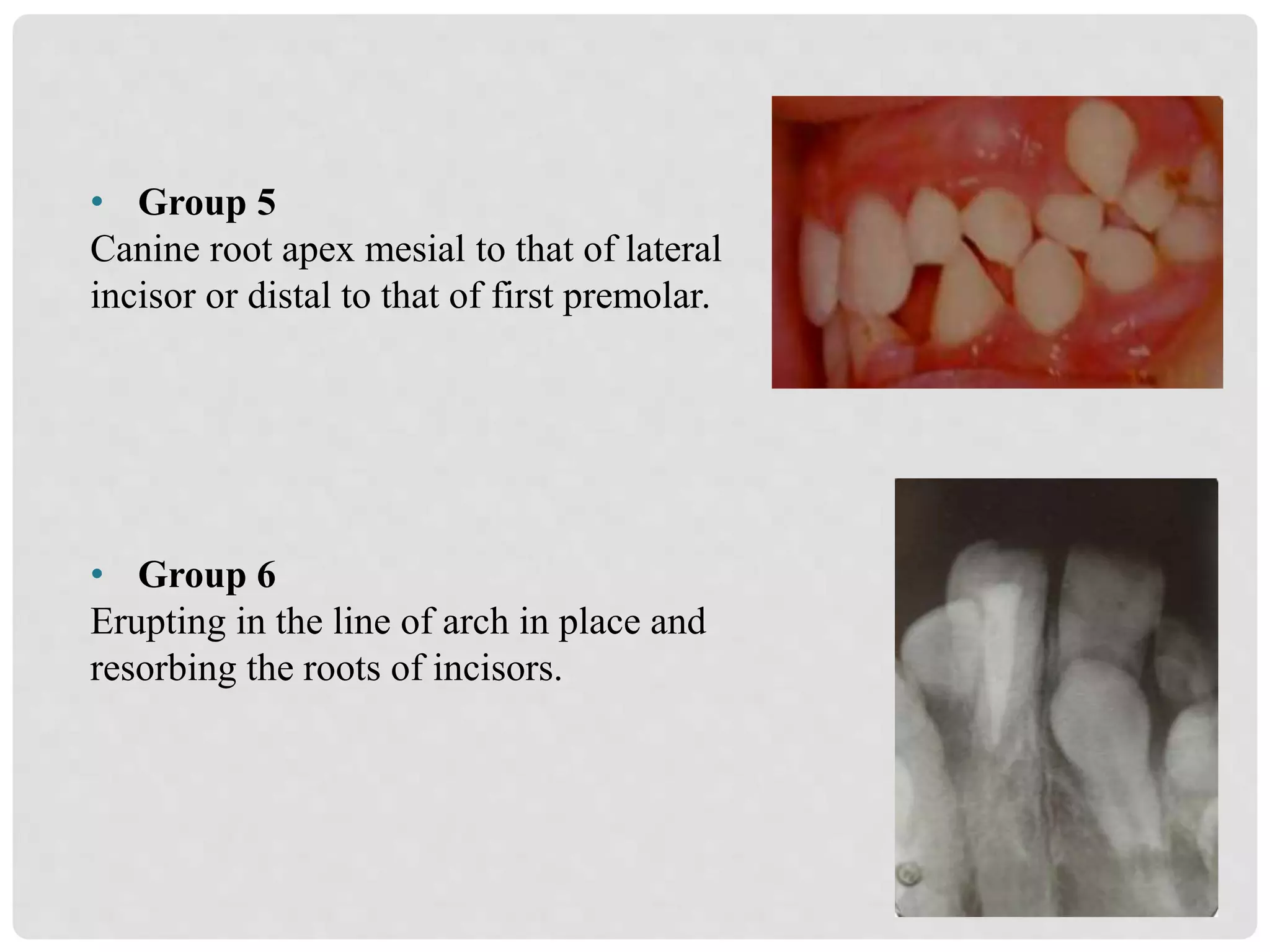 Management of impacted canines | PPTX