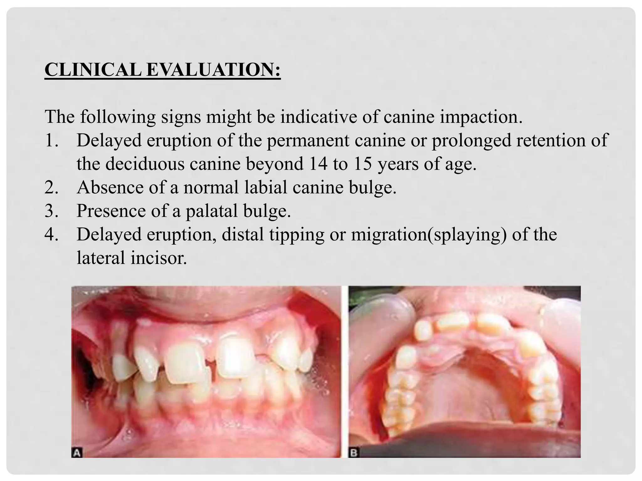 Management of impacted canines | PPTX