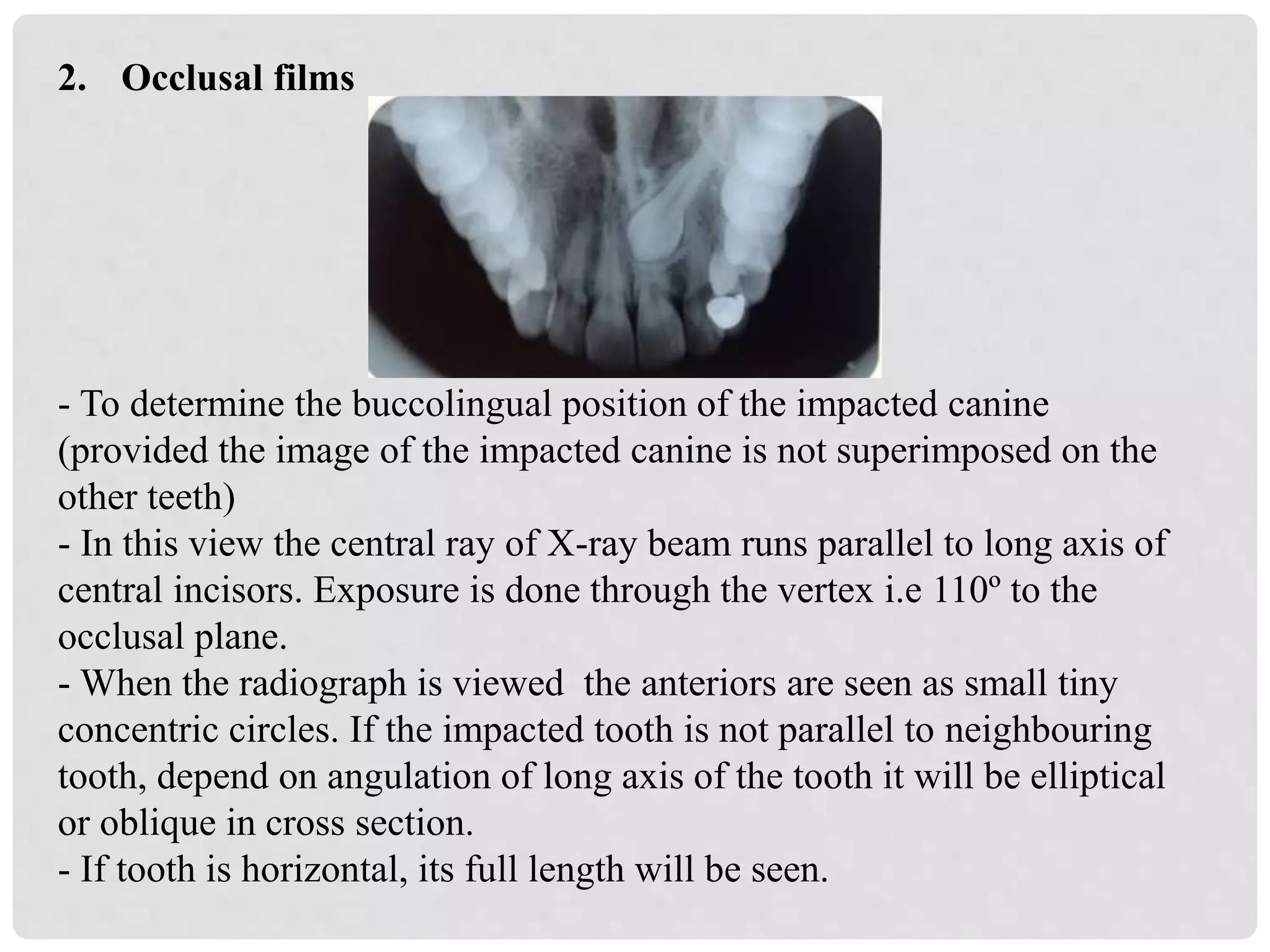 Management of impacted canines | PPTX