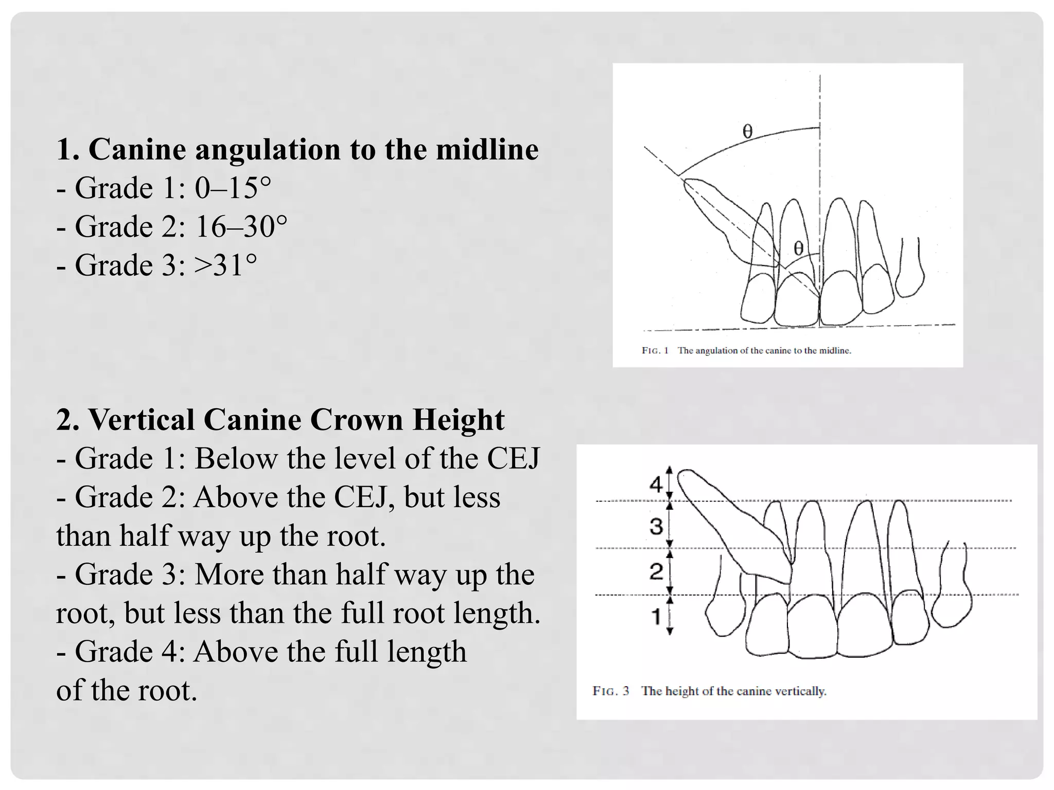 Management of impacted canines | PPTX