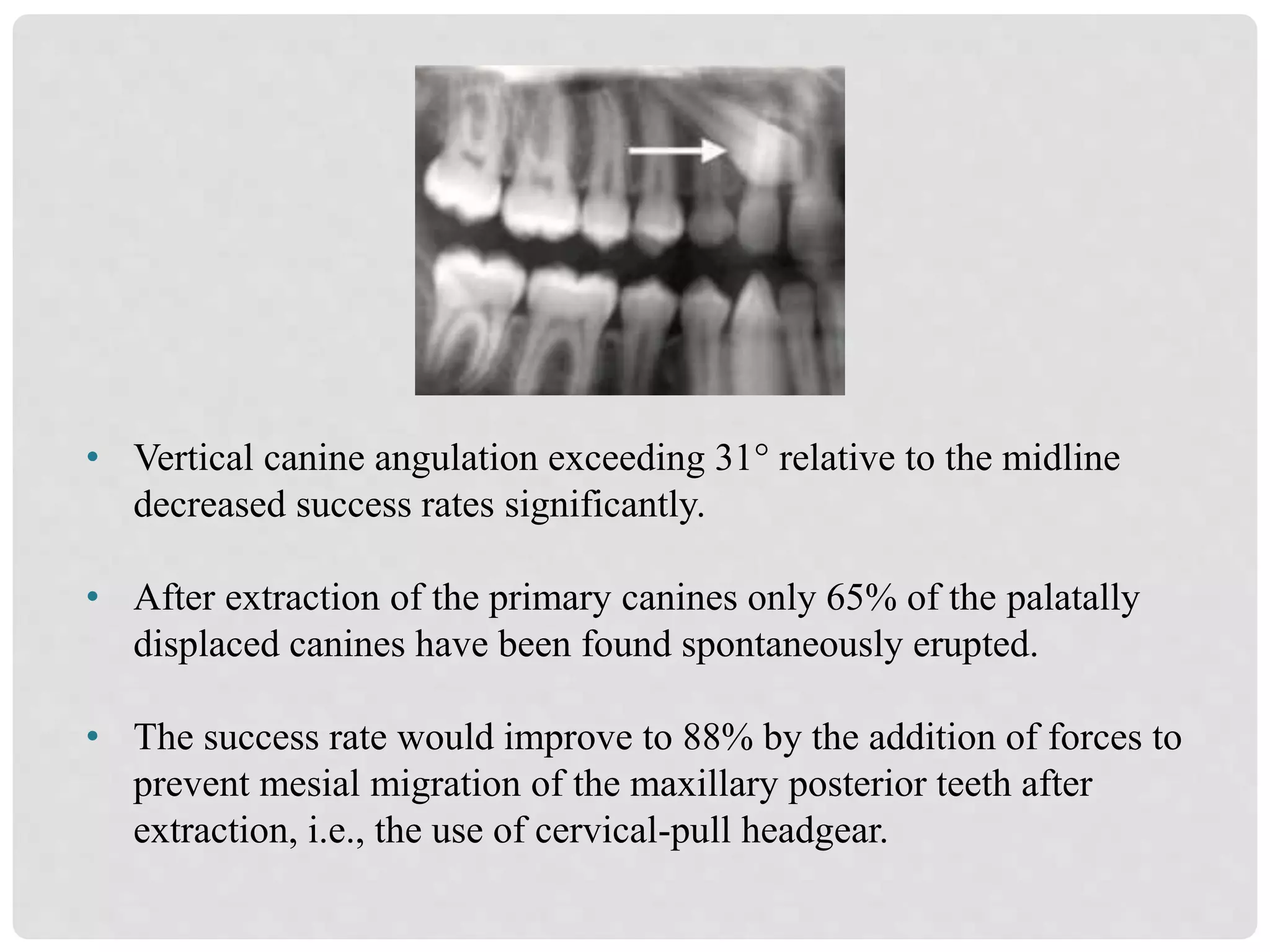 Management of impacted canines | PPTX