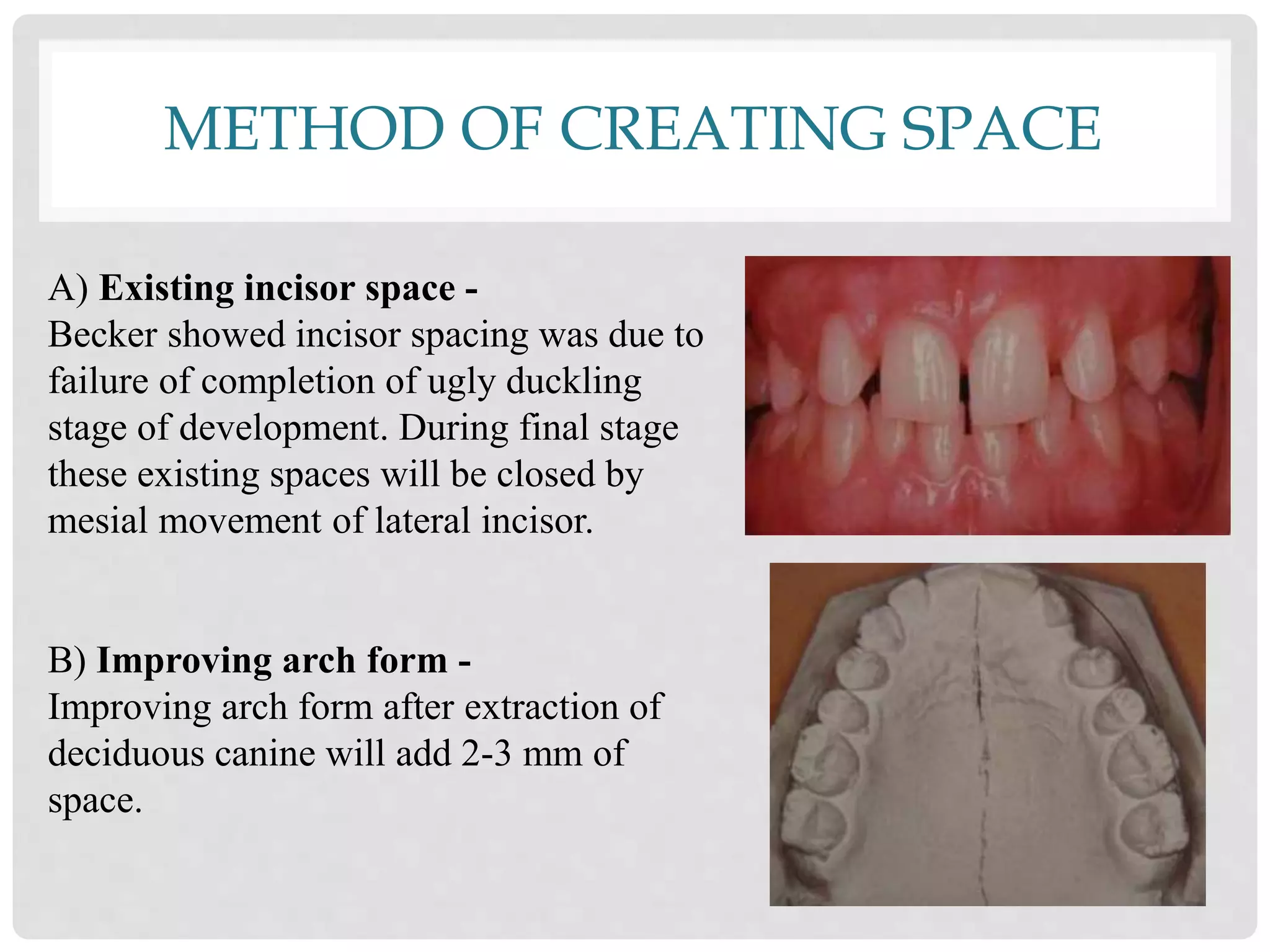 Management of impacted canines | PPTX