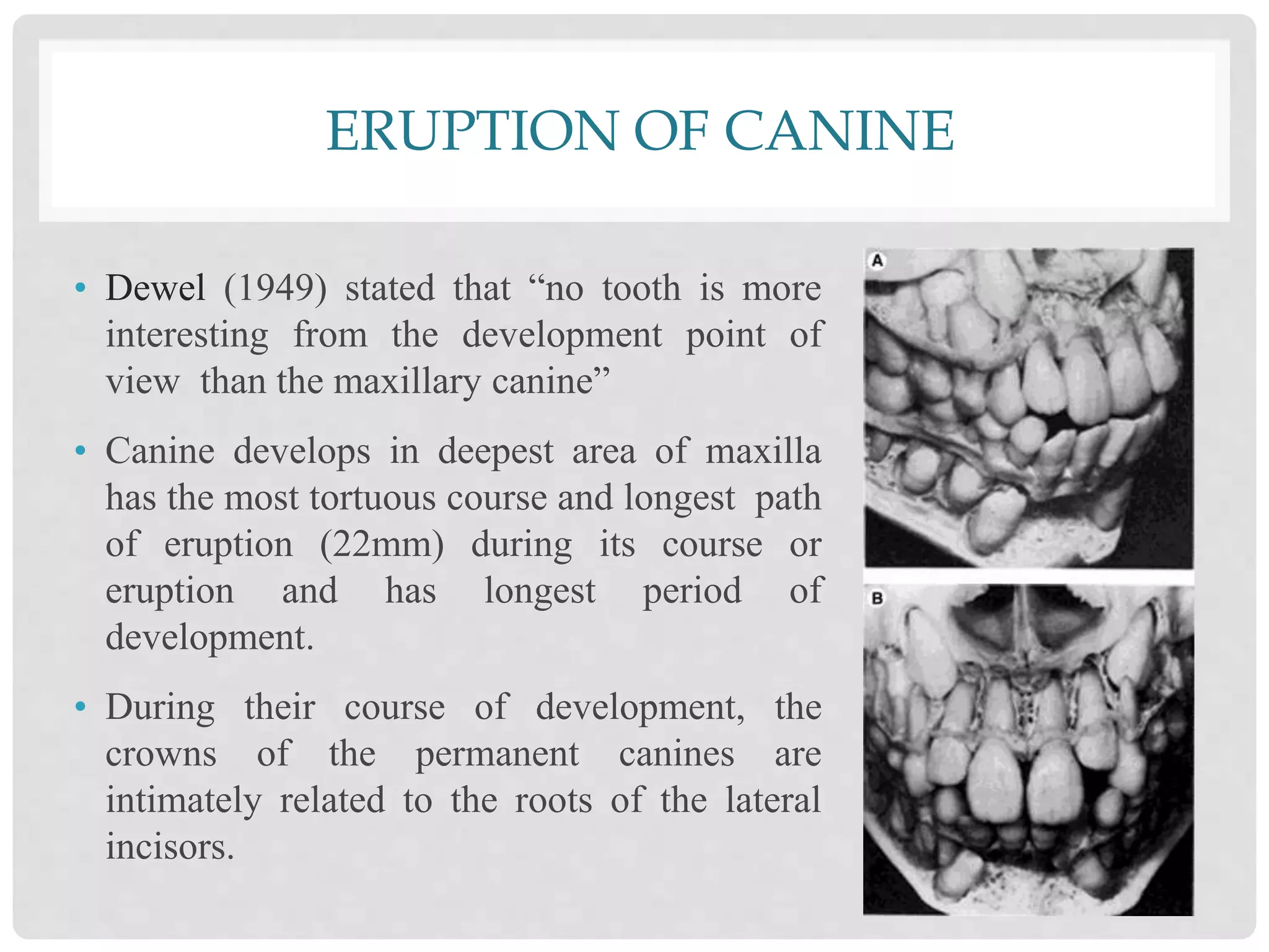 Management of impacted canines | PPTX