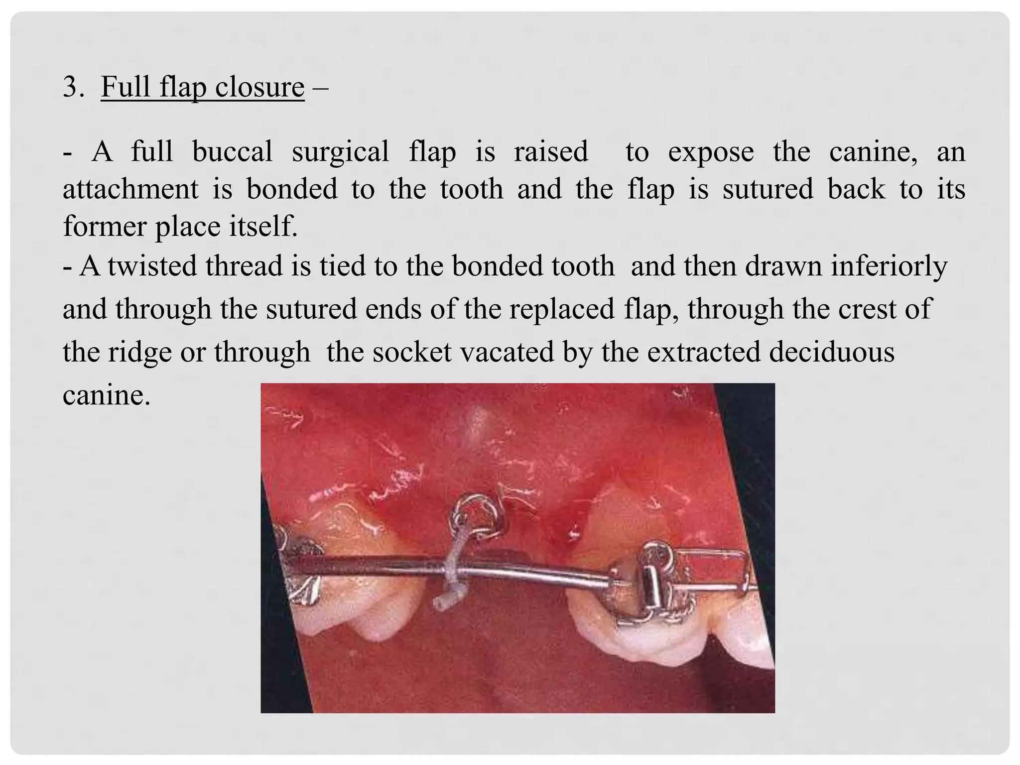 Management of impacted canines | PPTX