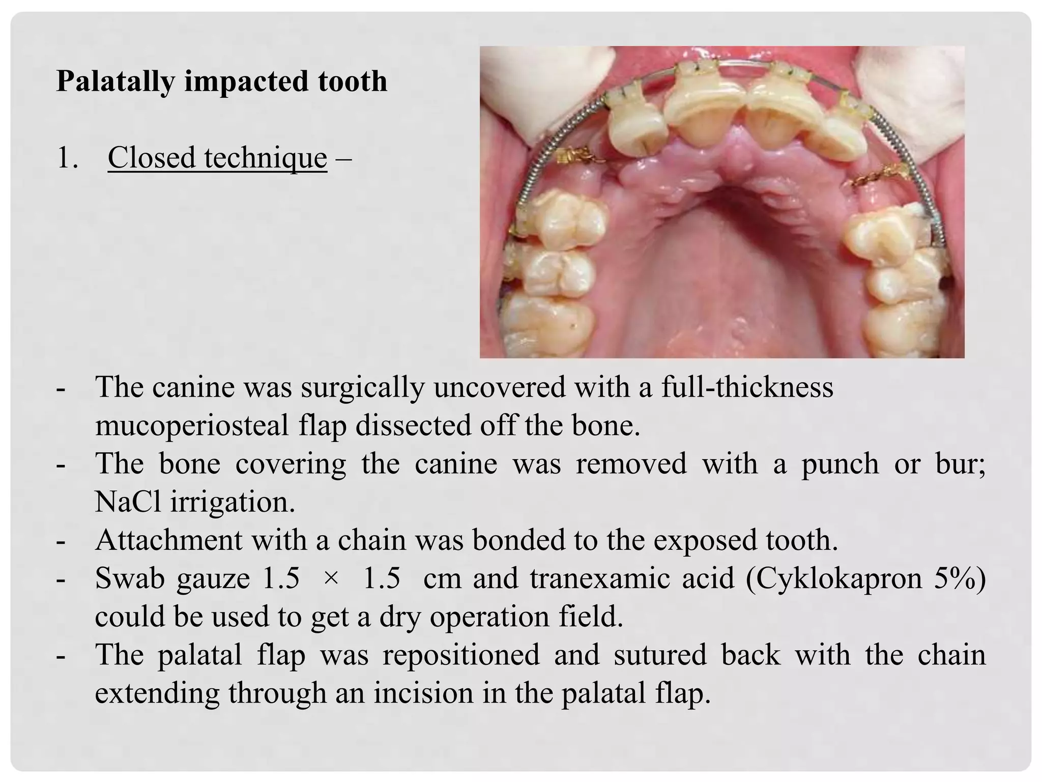 Management of impacted canines | PPTX