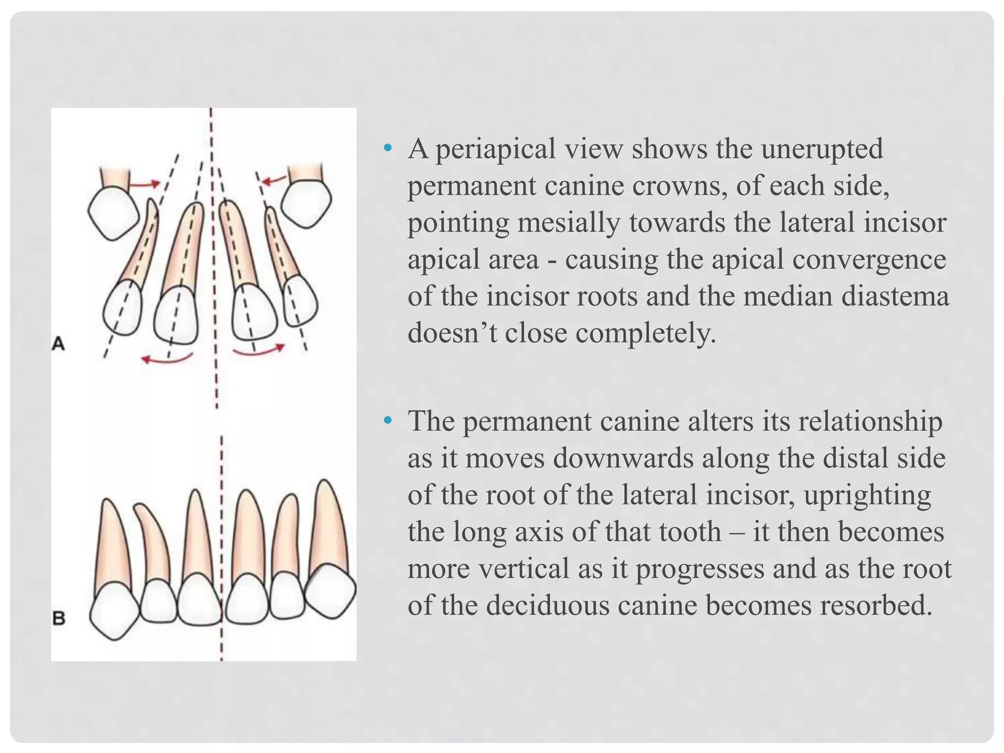 Management of impacted canines | PPTX