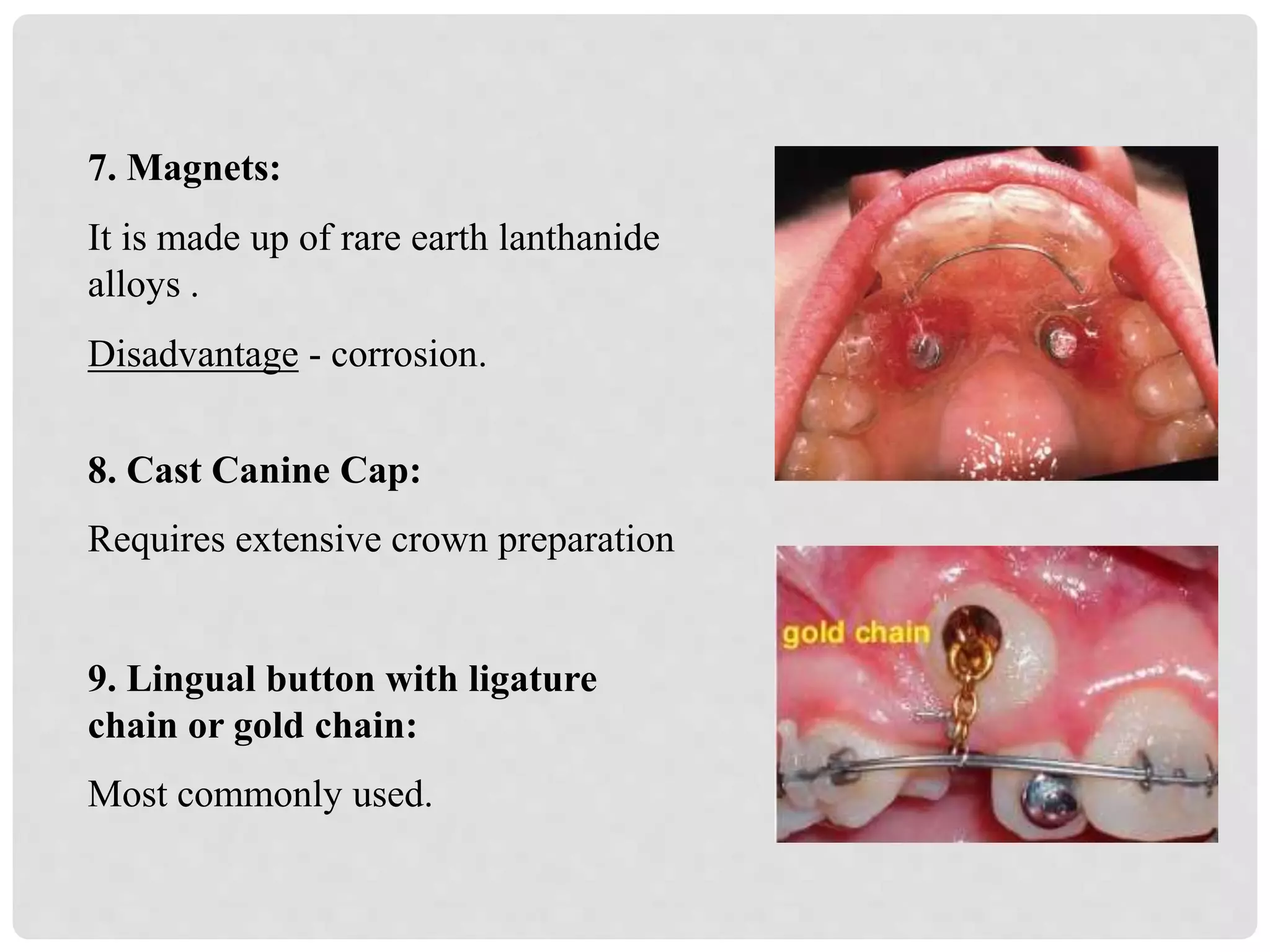 Management of impacted canines | PPTX