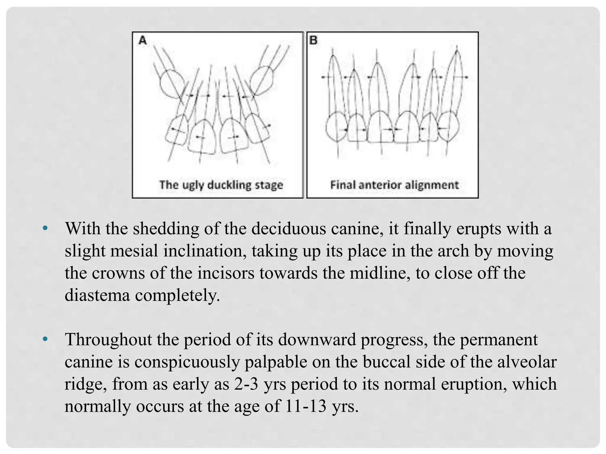 Management of impacted canines | PPTX