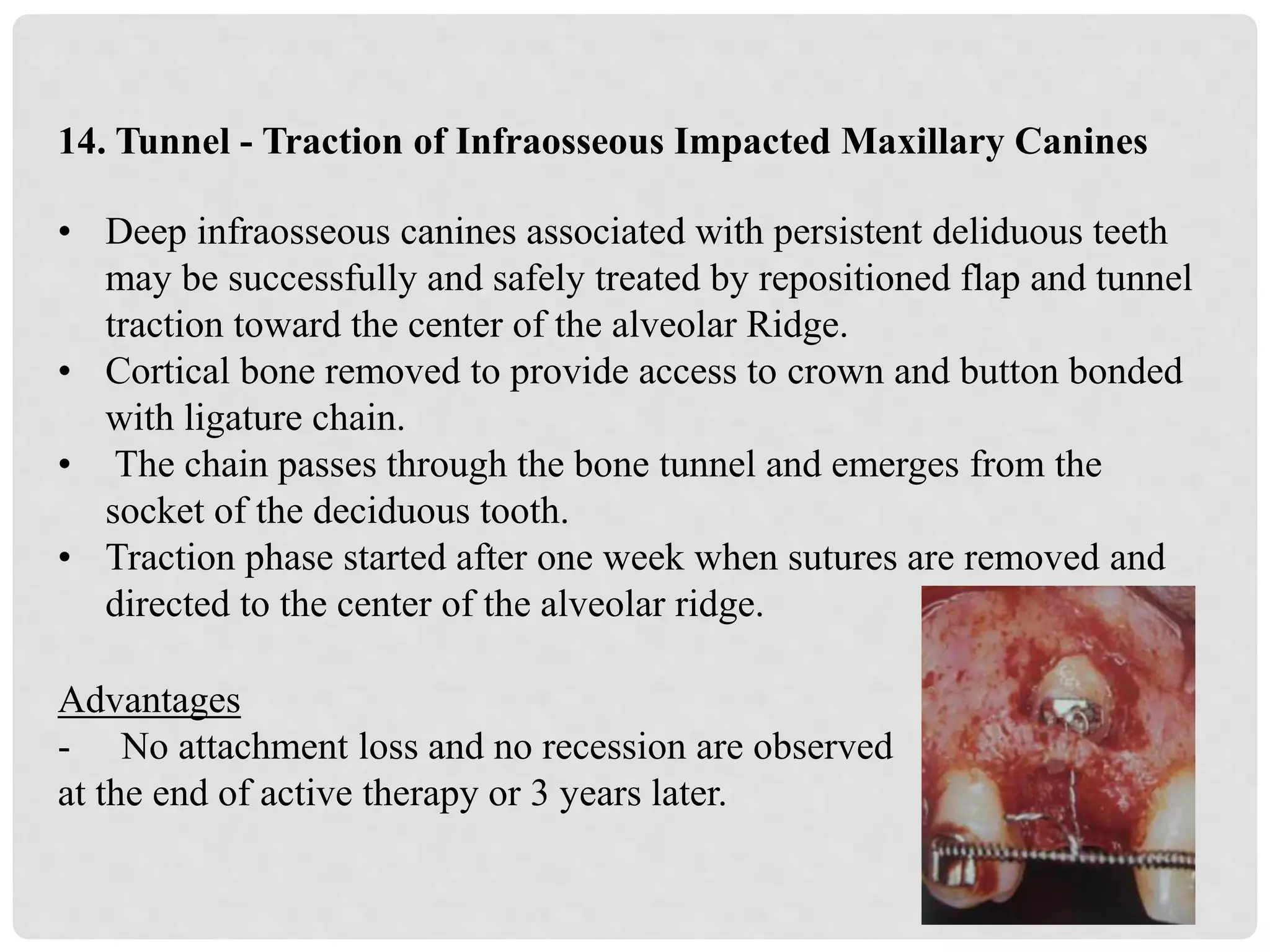Management of impacted canines | PPTX