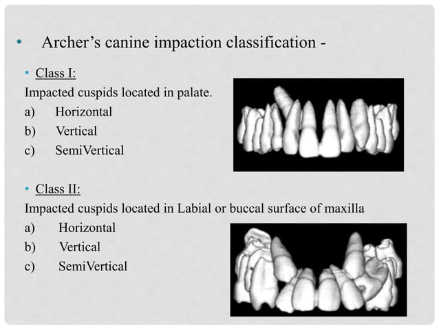 Management of impacted canines | PPTX | Dental Health | Diseases and ...