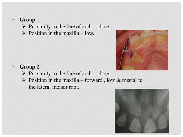Management of impacted canines | PPTX | Dental Health | Diseases and ...