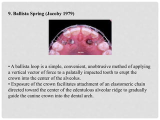 Management of impacted canines | PPTX