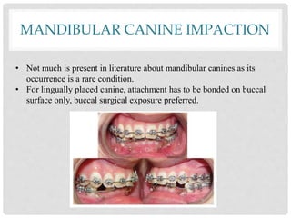 Management of impacted canines | PPTX