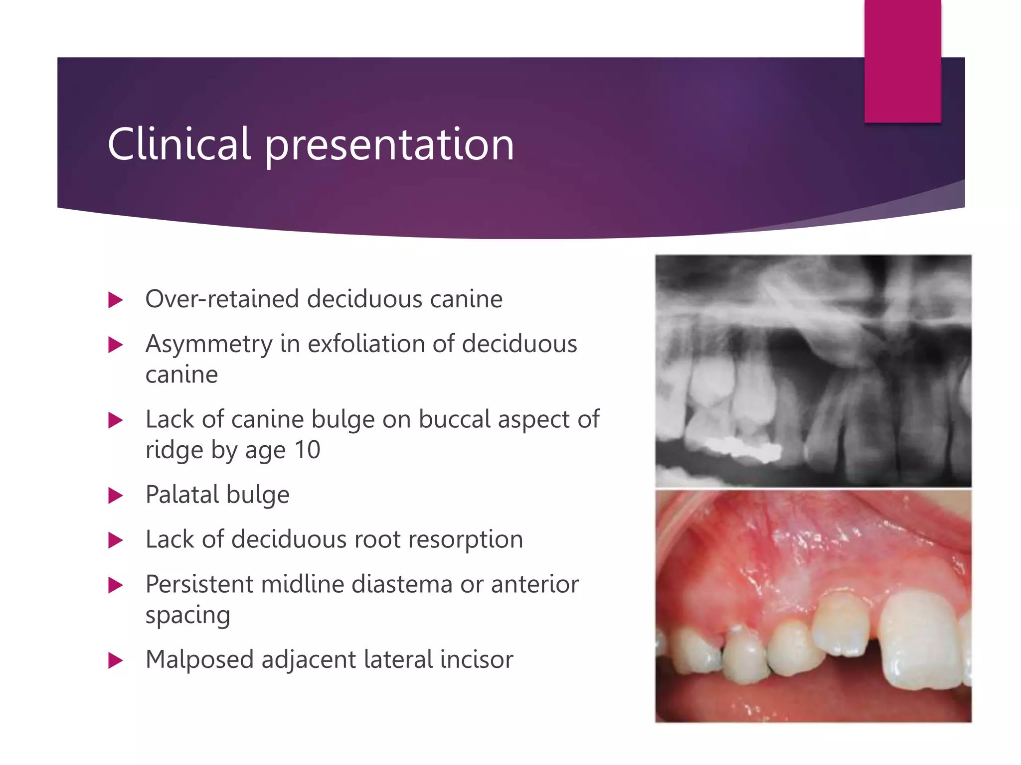 Management of impacted canines 2.pptx