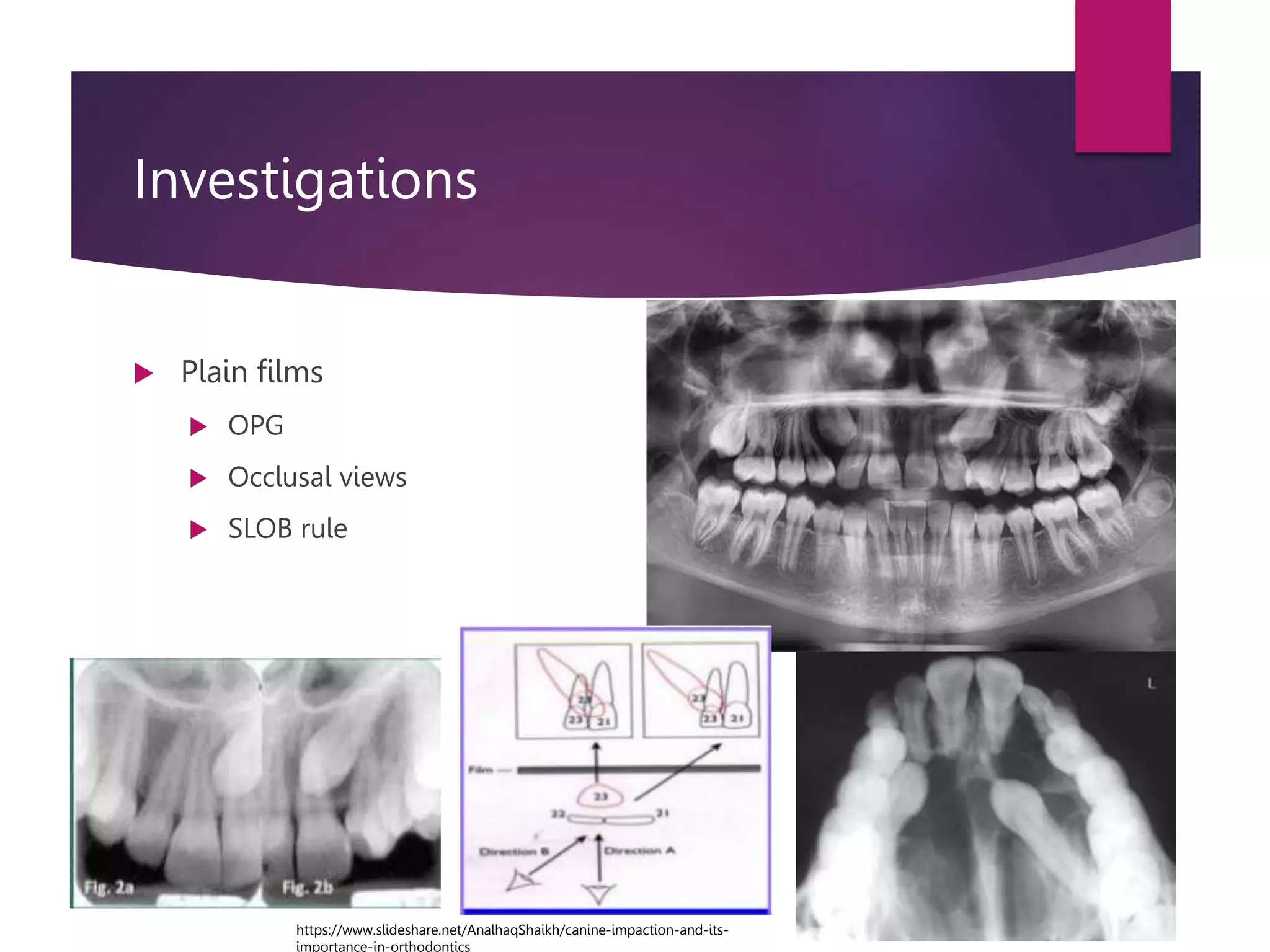 Management of impacted canines 2.pptx