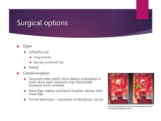 Management of impacted canines 2.pptx