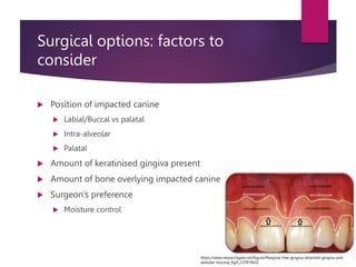 Management of impacted canines 2.pptx