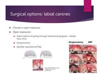 Management of impacted canines 2.pptx