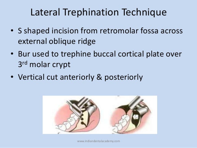 Management of impacted mandibular third molar /certified fixed orth…
