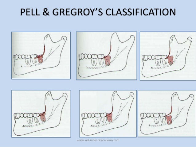 Management of impacted mandibular third molar /certified fixed orth…