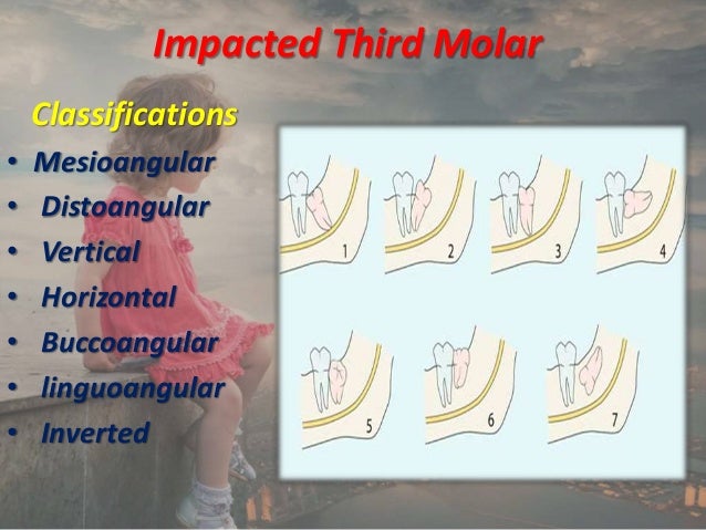 Management of impacted teeth