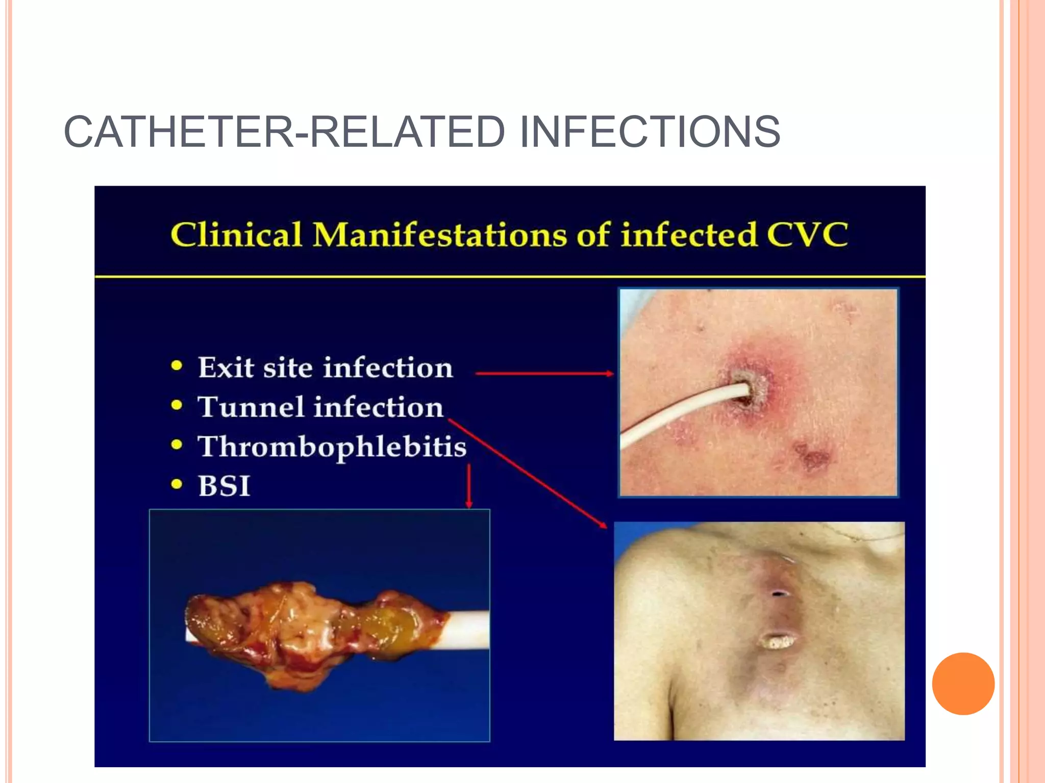 Management of infections in immunocompromised patients | PPTX