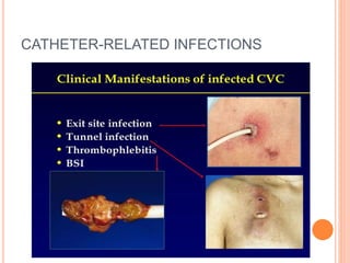 Management of infections in immunocompromised patients | PPTX