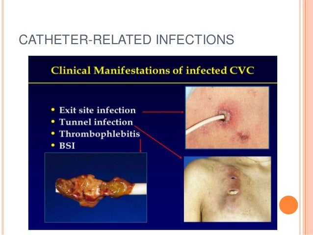 Management of infections in immunocompromised patients