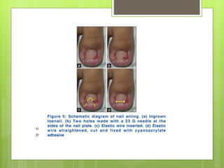 Ingrown Nail Diagram