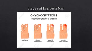 Management of ingrown toe nails | PPTX