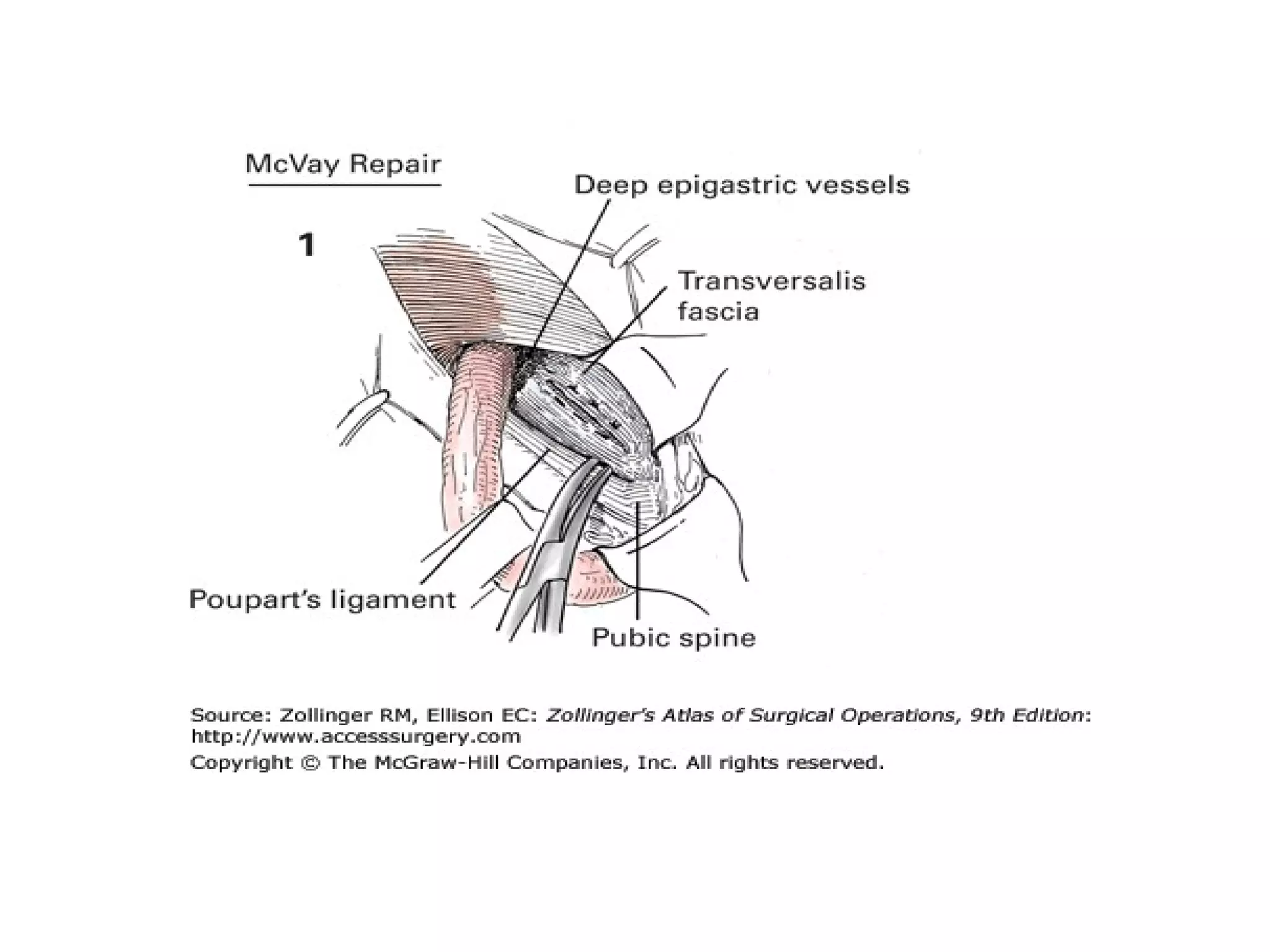 Management of inguinal hernia | PPT