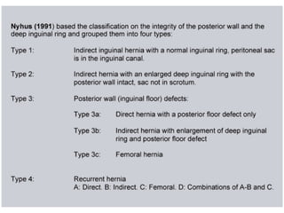 Management of inguinal hernia | PPT