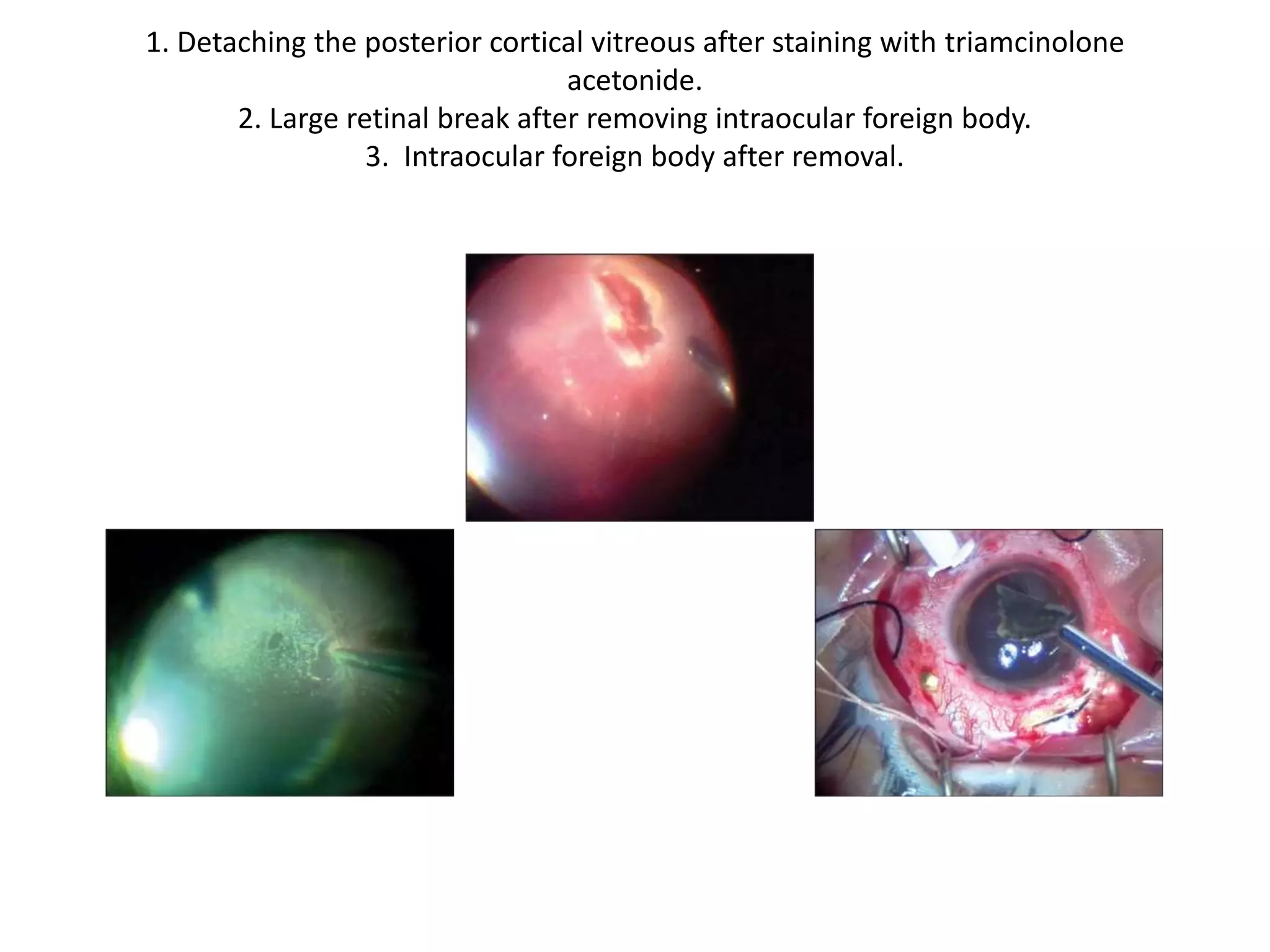 Management of intra ocular foreign body | PPTX