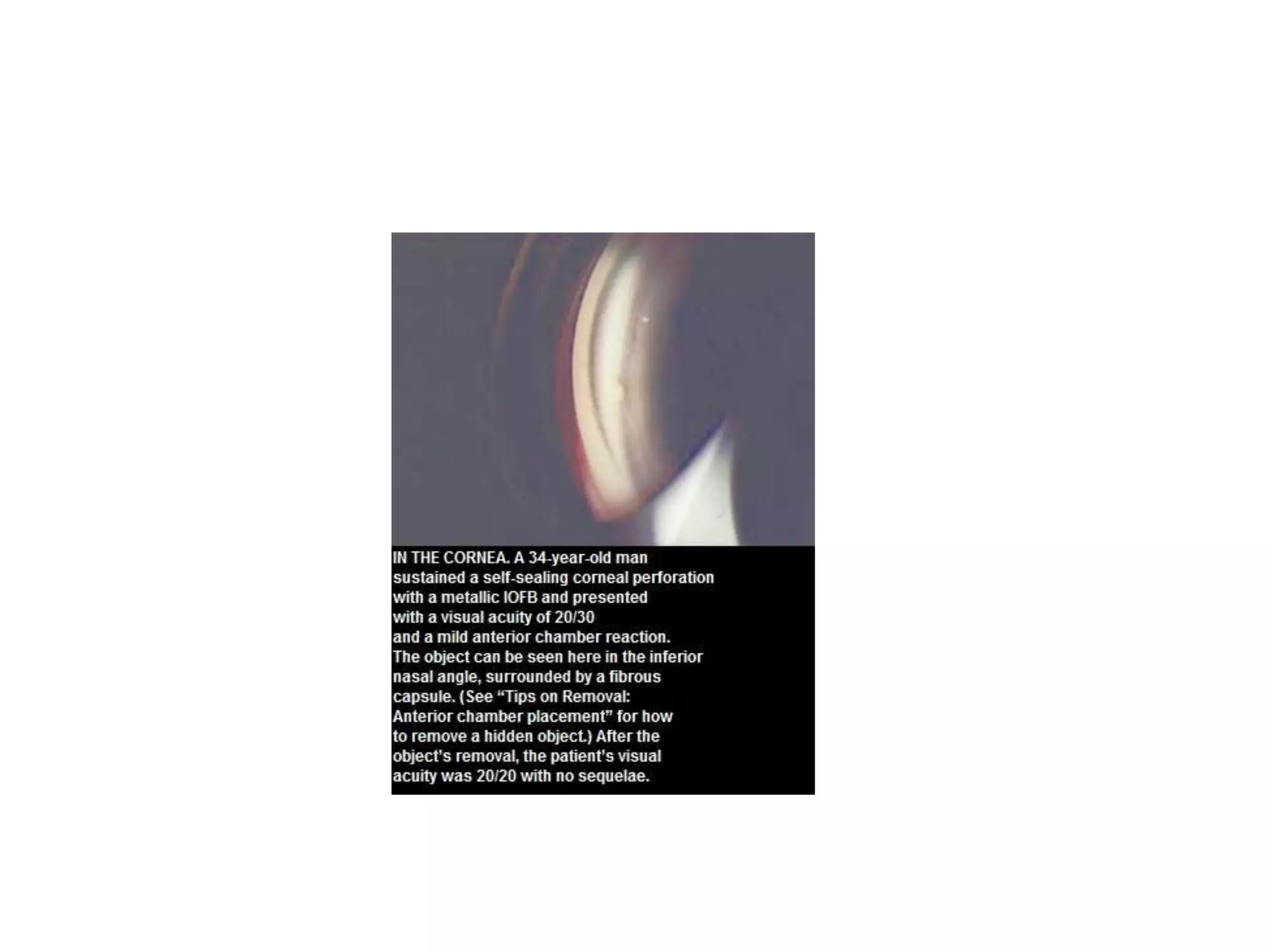 Management of intra ocular foreign body | PPTX