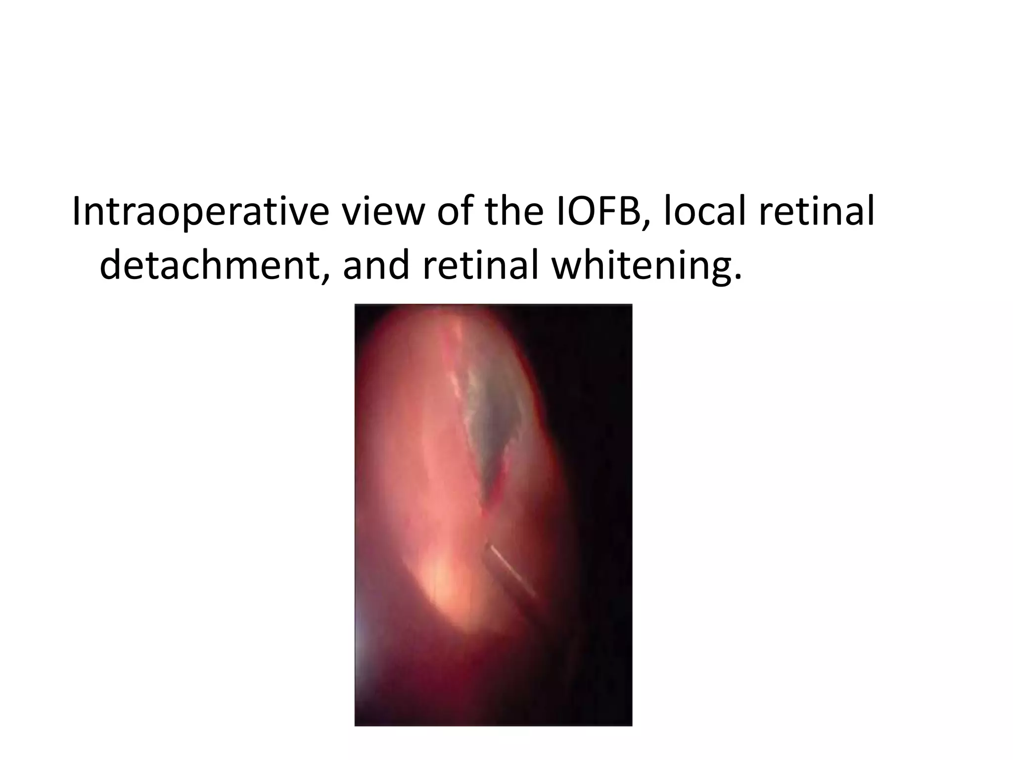 Management of intra ocular foreign body | PPTX