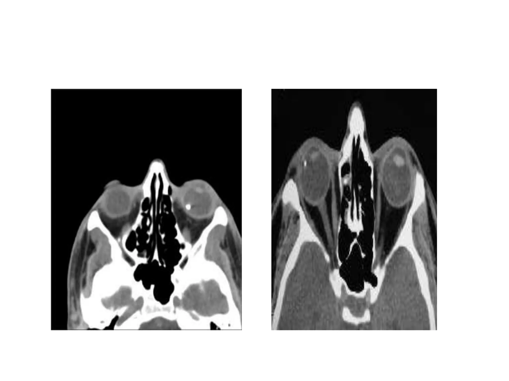 Management of intra ocular foreign body | PPTX