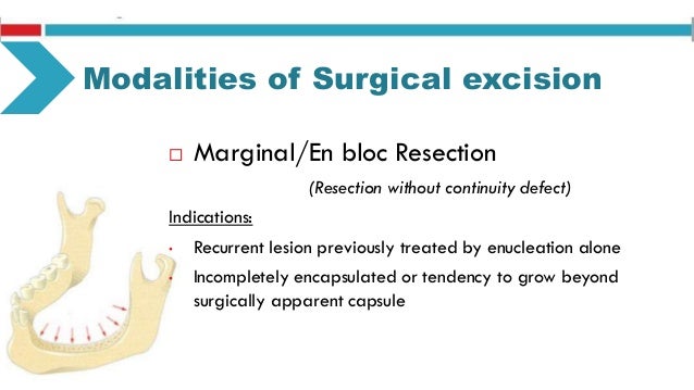 Management of jaw tumors
